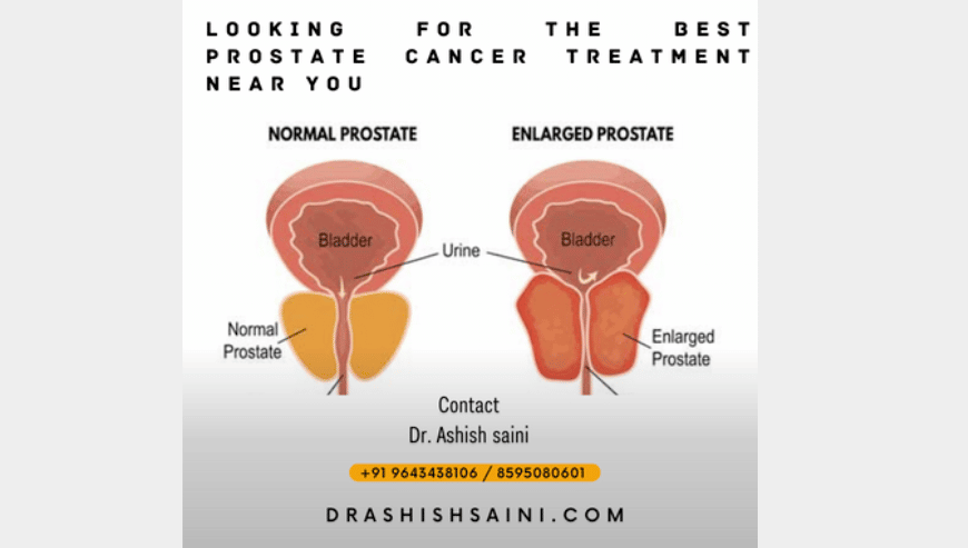 Holmium Laser Enucleation of The Prostate in India