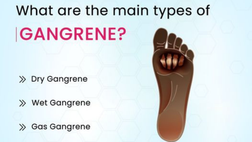 Types of Gangrene