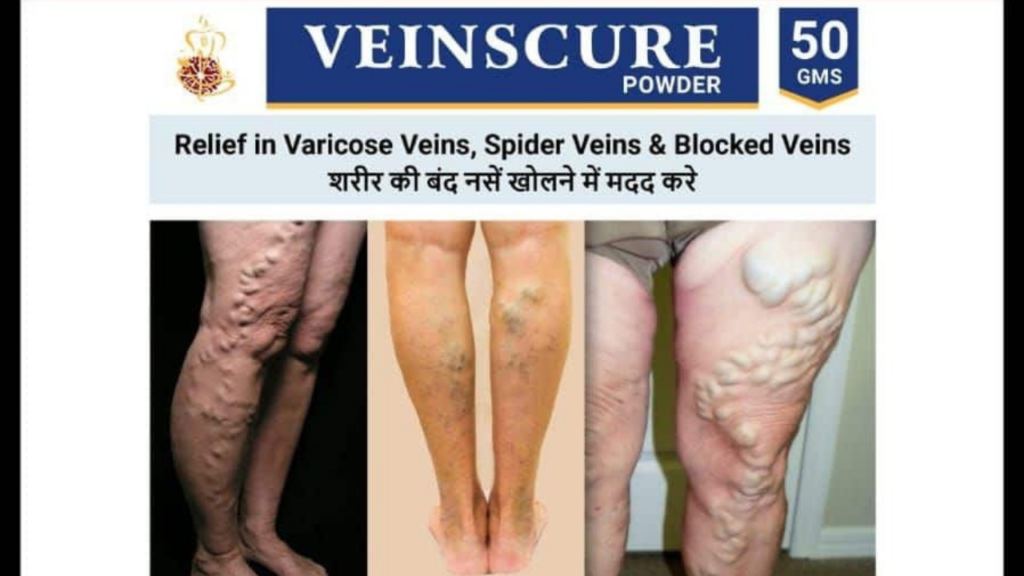Veinscure Powder - Ayurvedic Medicine For Varicose Veins, Spider Veins ...